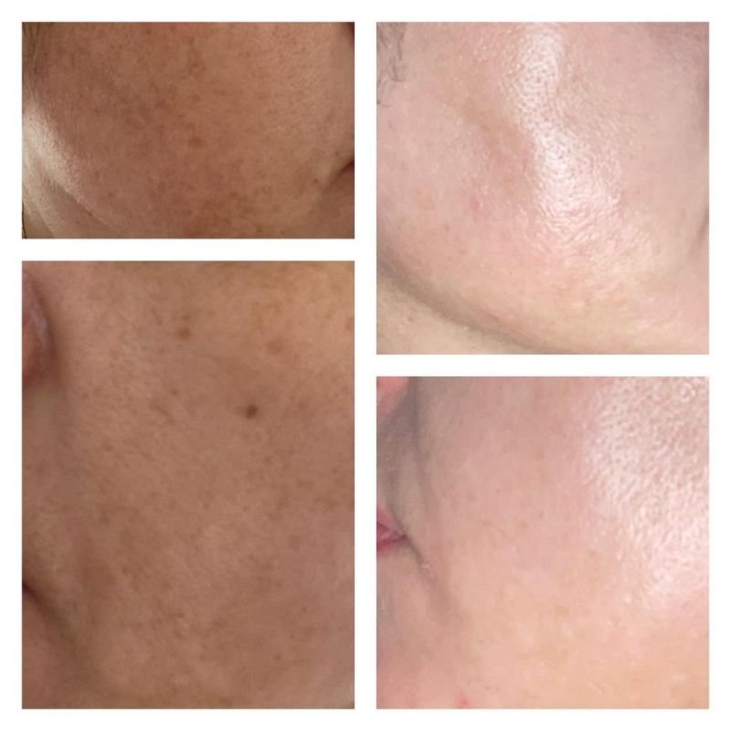Depigmentation and Melasma Treatment - The Skin Project London ...